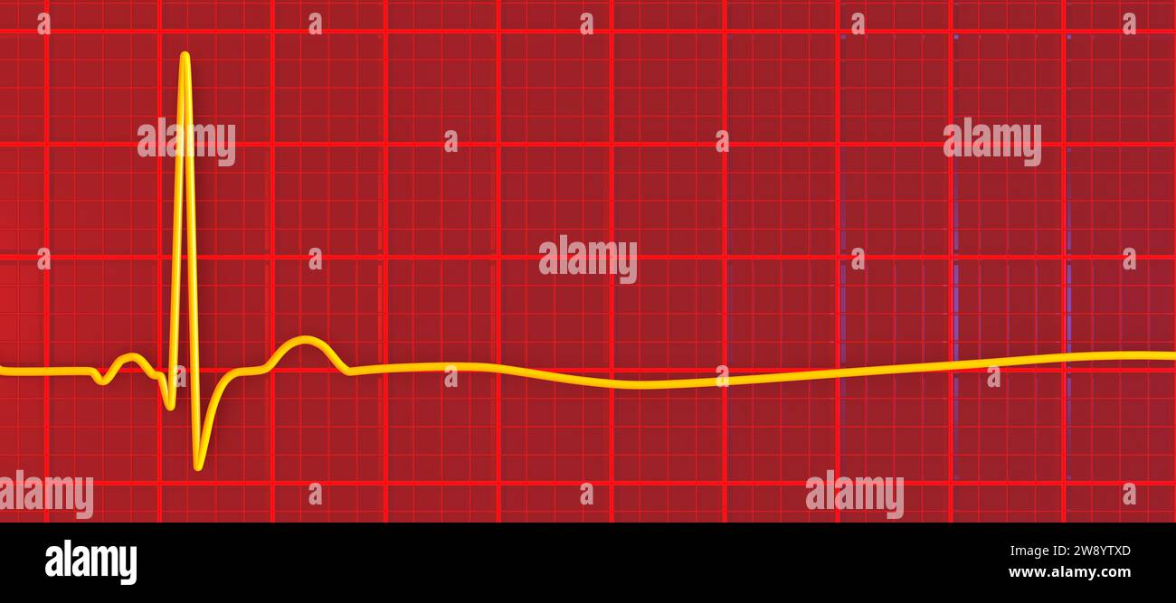 Asystole cardiac arrest, illustration Stock Photo - Alamy