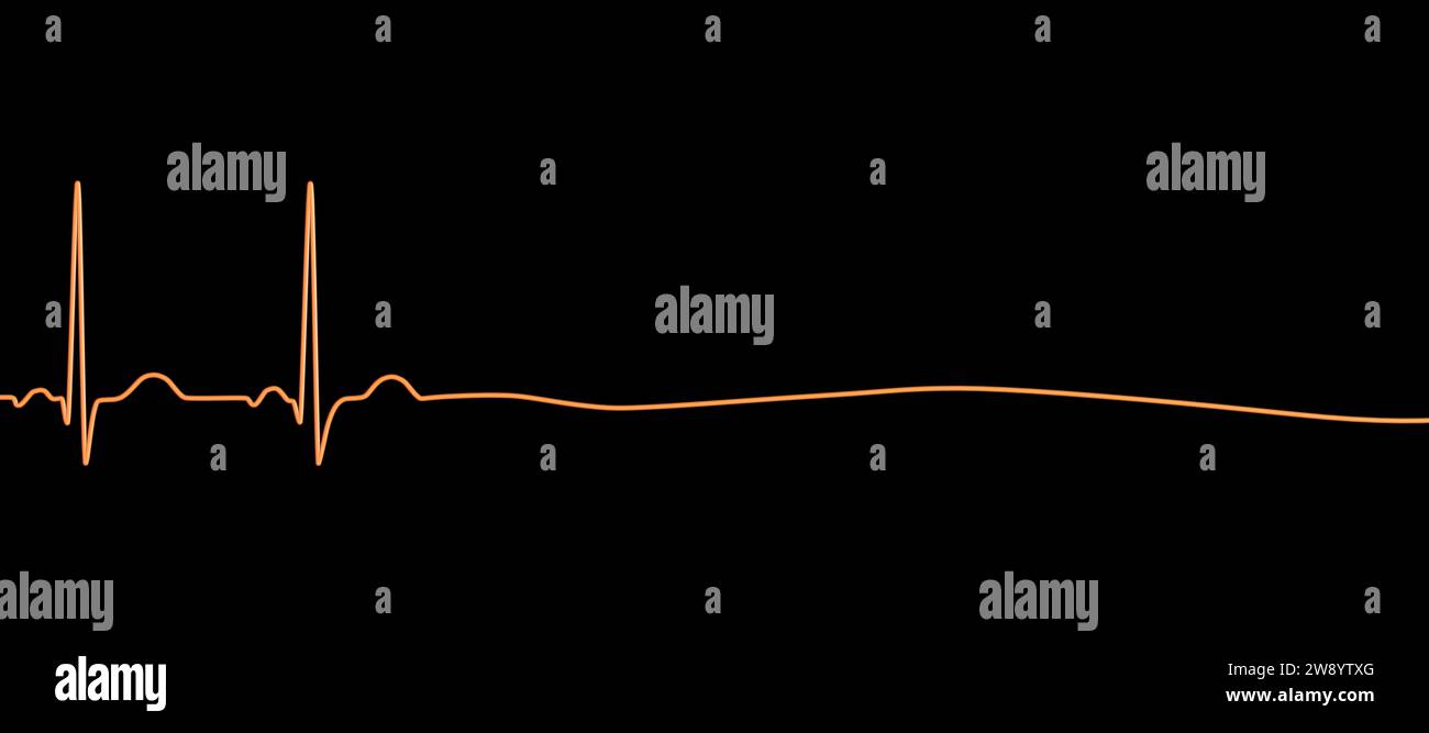 Asystole cardiac arrest, illustration Stock Photo - Alamy