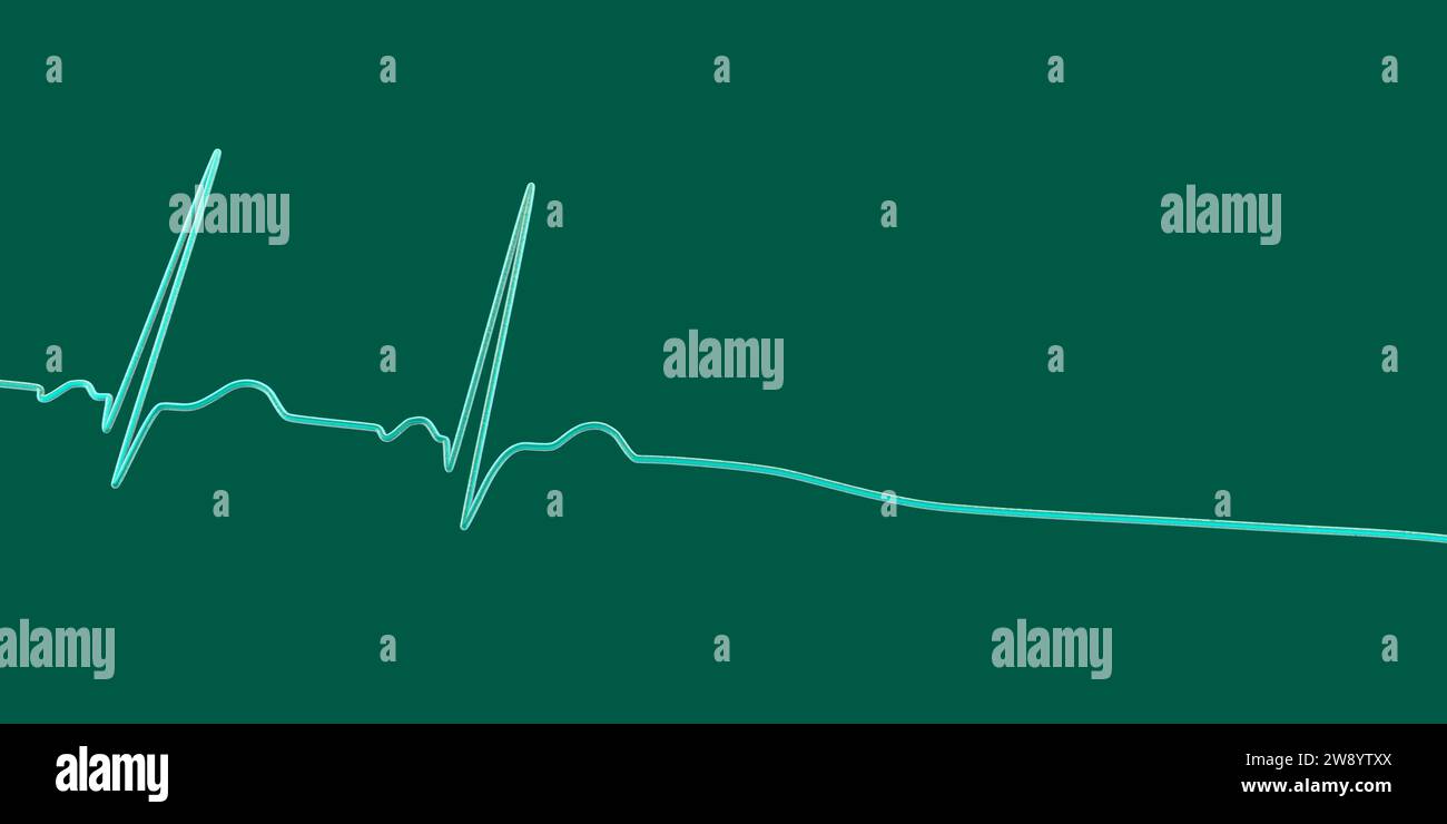 Asystole cardiac arrest, illustration Stock Photo - Alamy