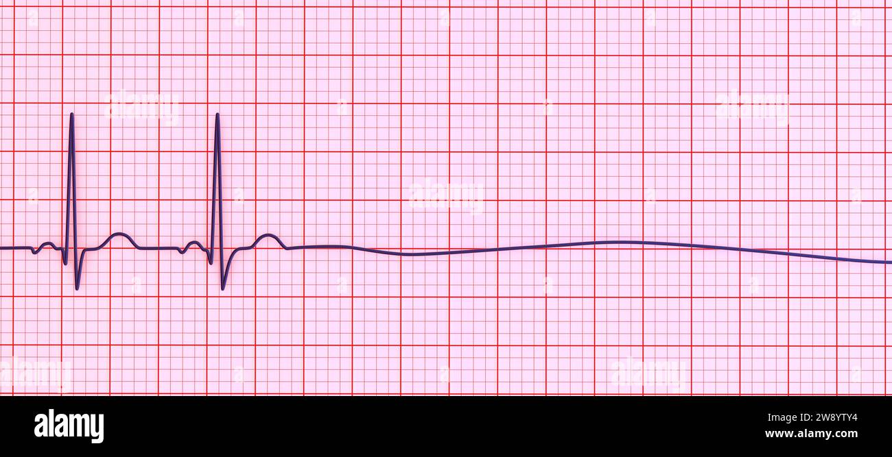 Illustration showing a flatline on an electrocardiogram (ECG), signifying the critical condition ...