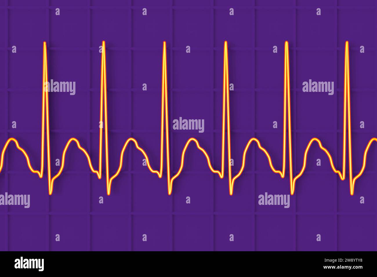 Illustration depicting an atrial flutter abnormal heart rhythm on an ...