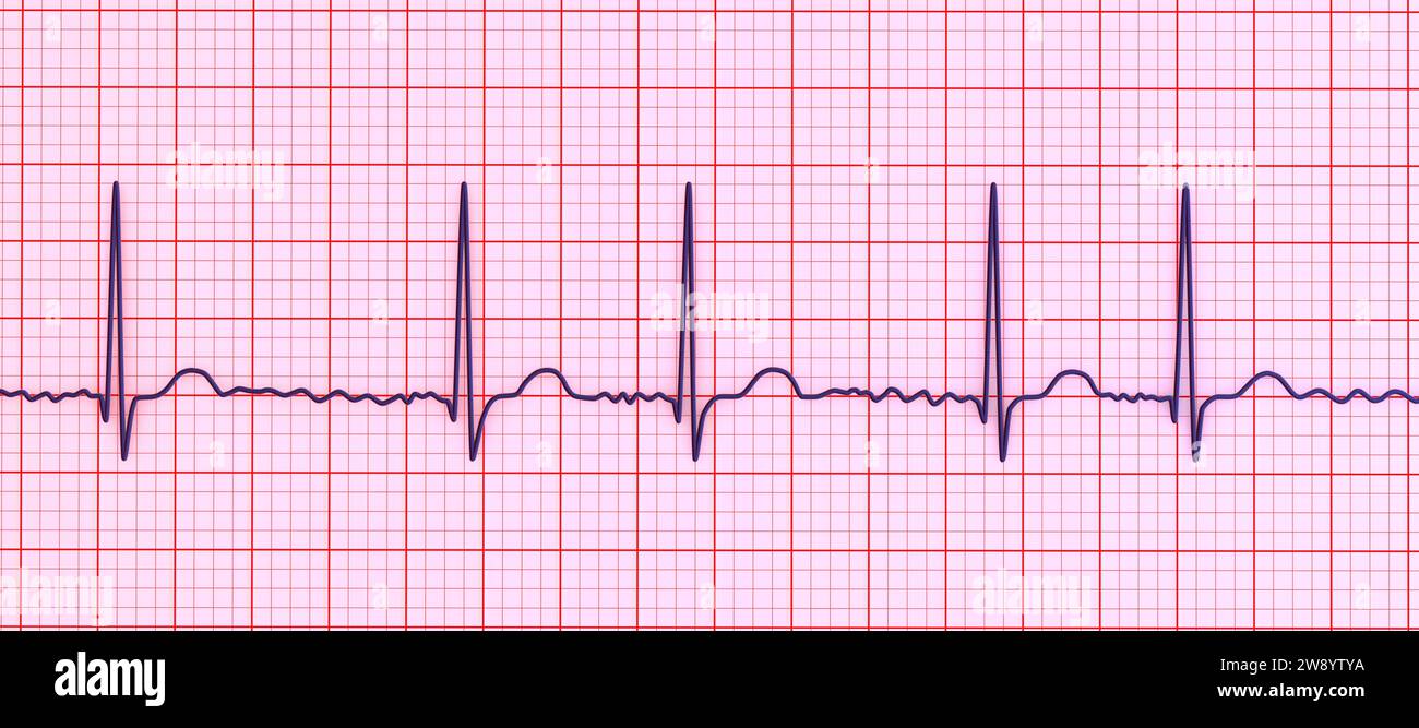 Illustration depicting an atrial fibrillation (AFib) heartbeat rhythm on an electrocardiogram ...