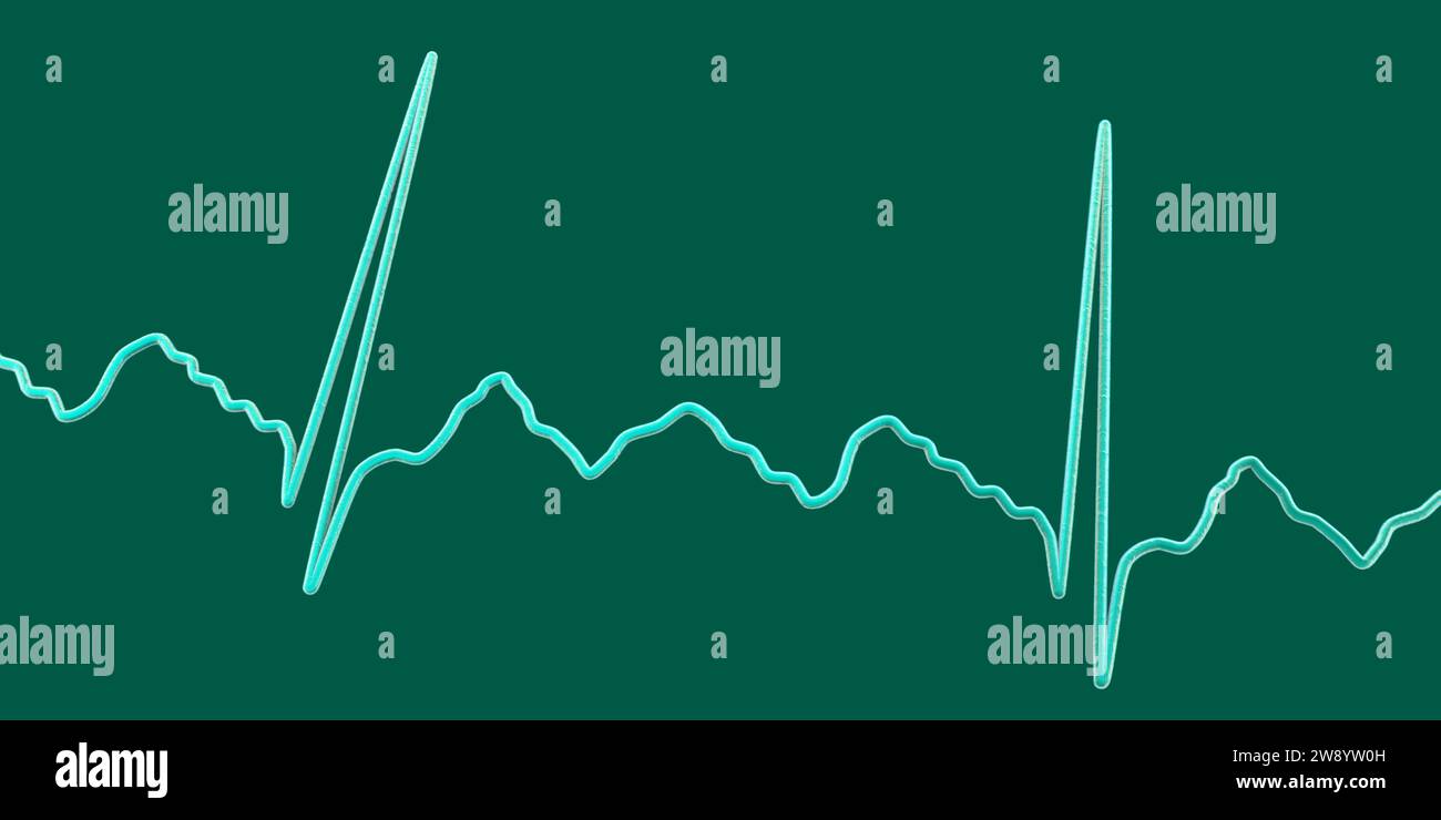 Atrial flutter abnormal heartbeat rhythm, illustration Stock Photo - Alamy