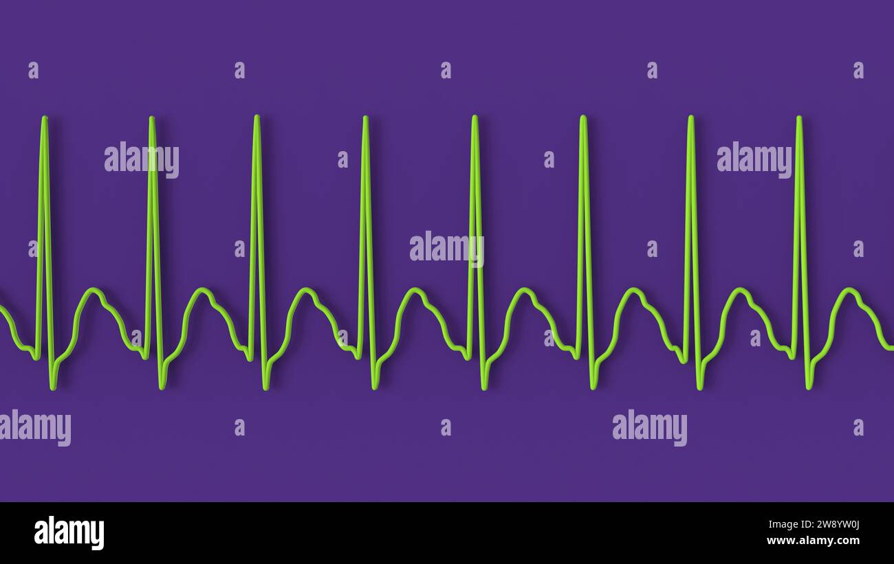 Illustration depicting an atrial flutter abnormal heart rhythm on an ...