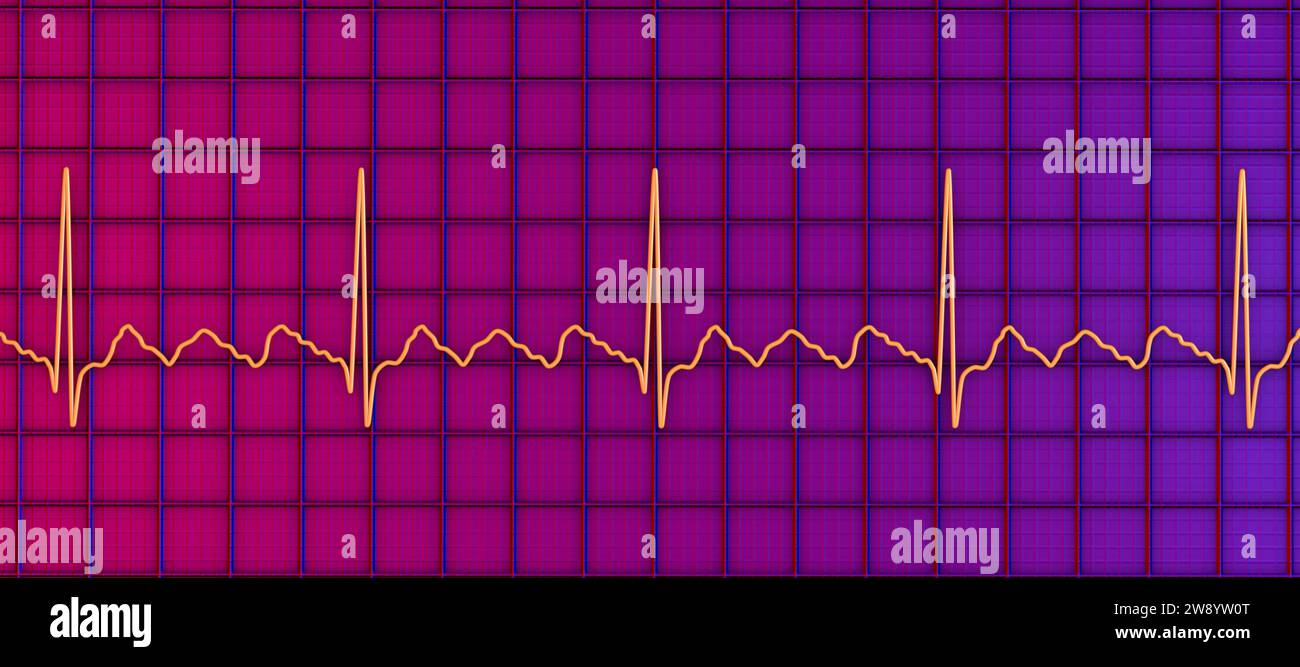 Atrial flutter abnormal heartbeat rhythm, illustration Stock Photo - Alamy