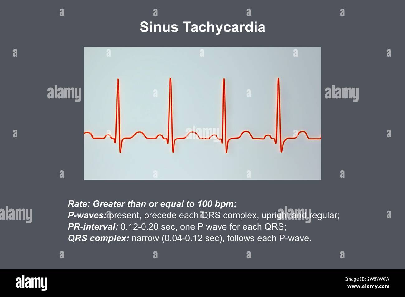 Illustration of an electrocardiogram (ECG) showing sinus tachycardia, a ...