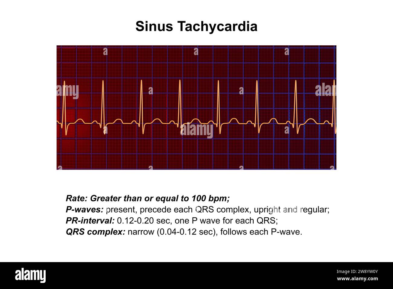 Sinus tachycardia heartbeat rhythm, illustration Stock Photo - Alamy