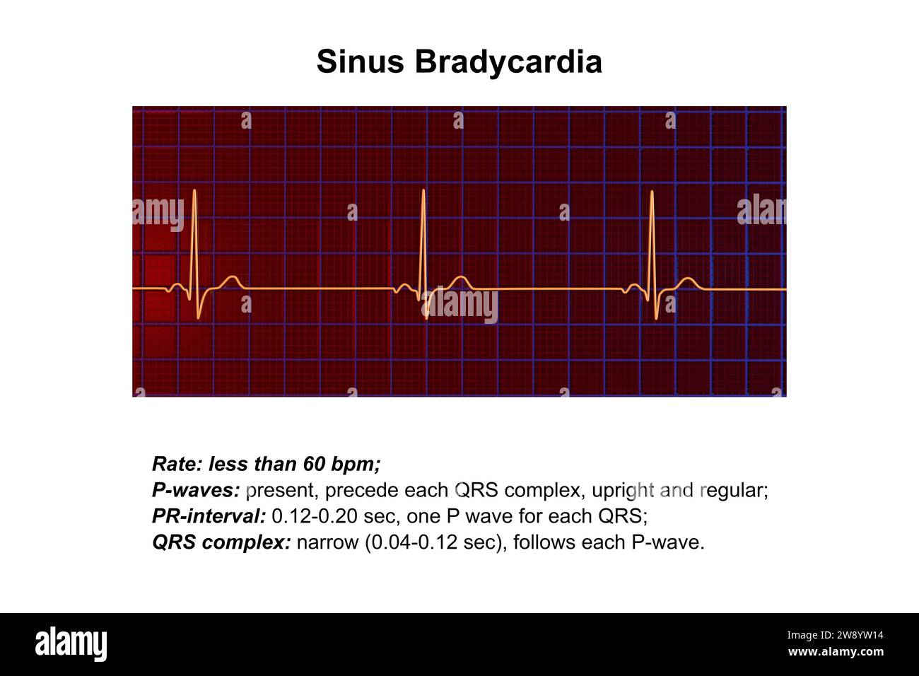 Sinus bradycardia heartbeat rhythm, illustration Stock Photo - Alamy