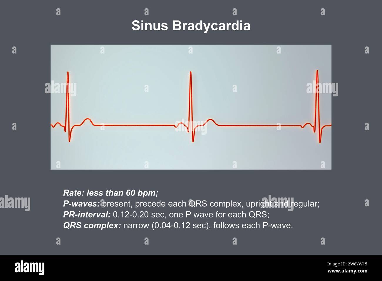 Bradycardia hi-res stock photography and images - Alamy