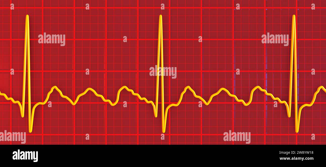 Illustration depicting an atrial flutter abnormal heart rhythm on an ...