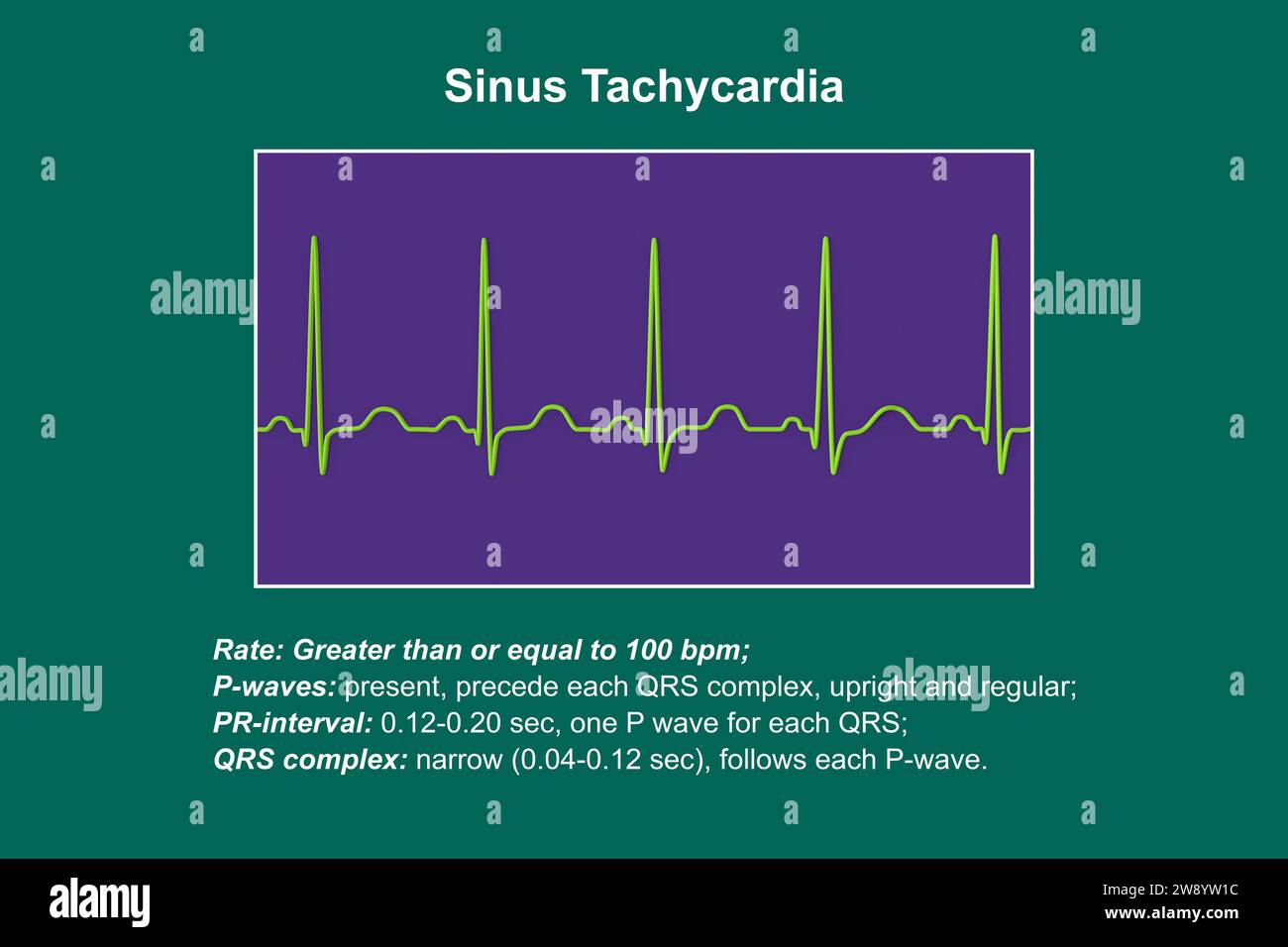Illustration of an electrocardiogram (ECG) showing sinus tachycardia, a ...