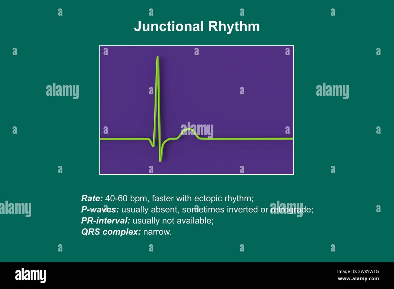 Junctional rhythm of the heartbeat, illustration Stock Photo - Alamy