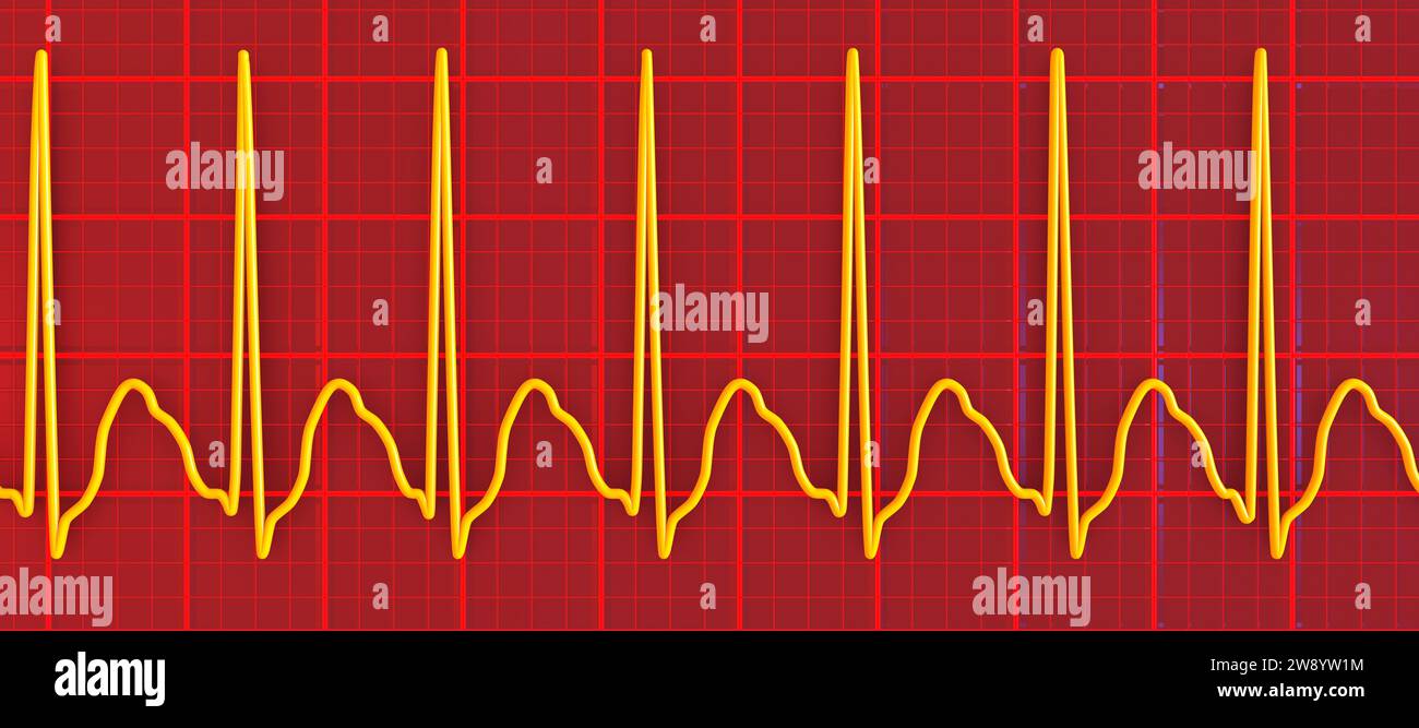 Supraventricular Tachycardia Svt Causes Symptoms