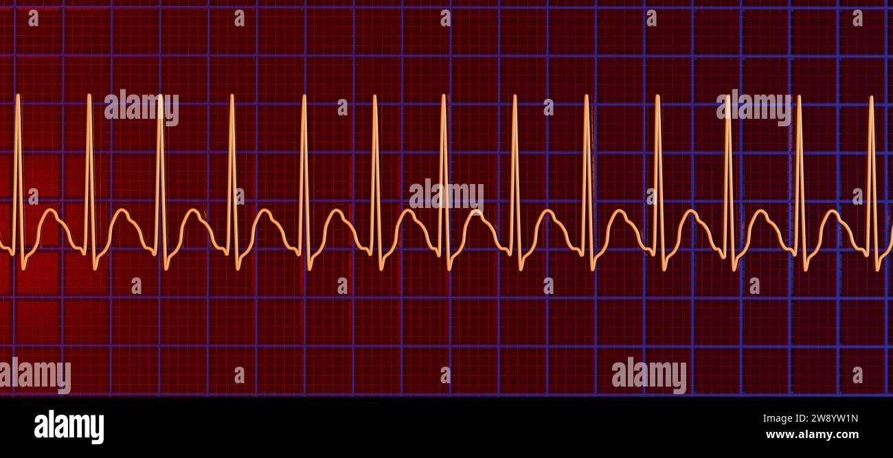 Supraventricular tachycardia heartbeat rhythm, illustration Stock Photo ...