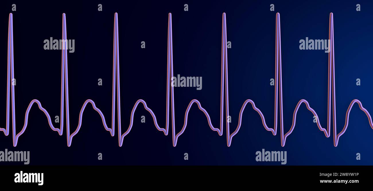 Supraventricular tachycardia heartbeat rhythm, illustration Stock Photo ...