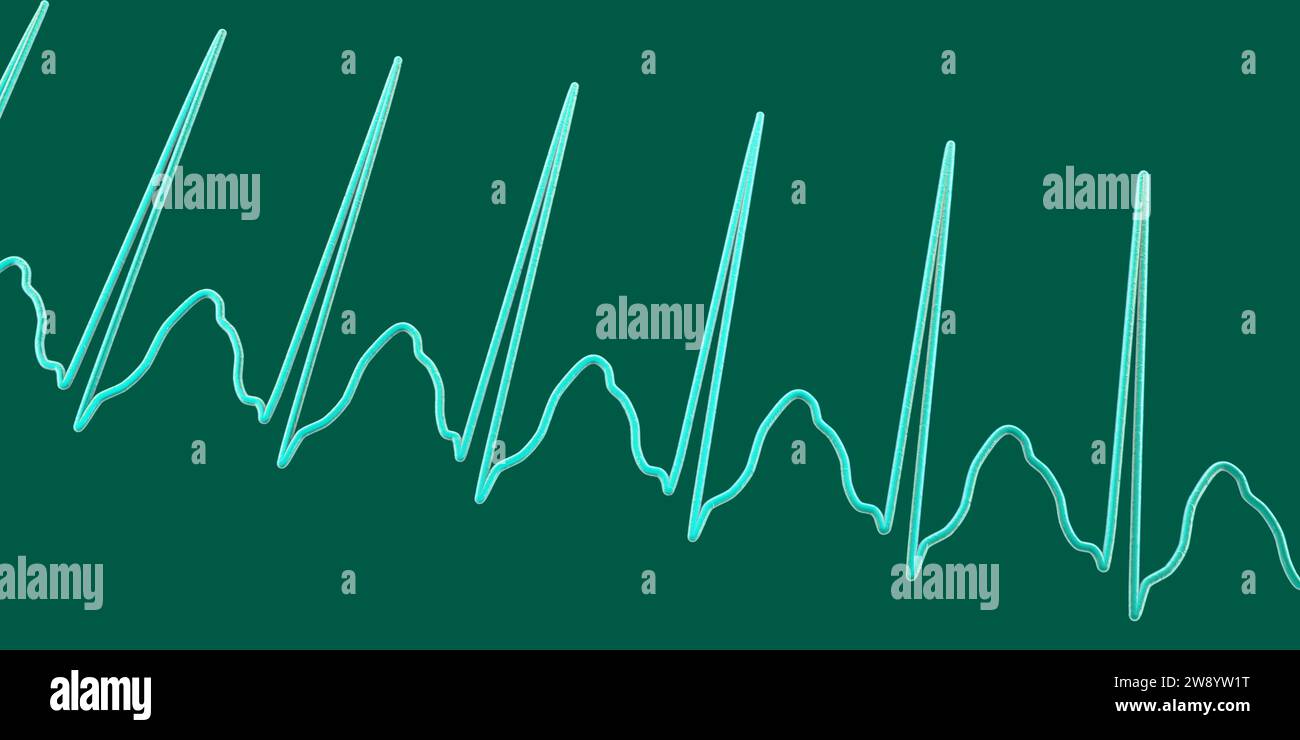 Supraventricular tachycardia heartbeat rhythm, illustration Stock Photo ...