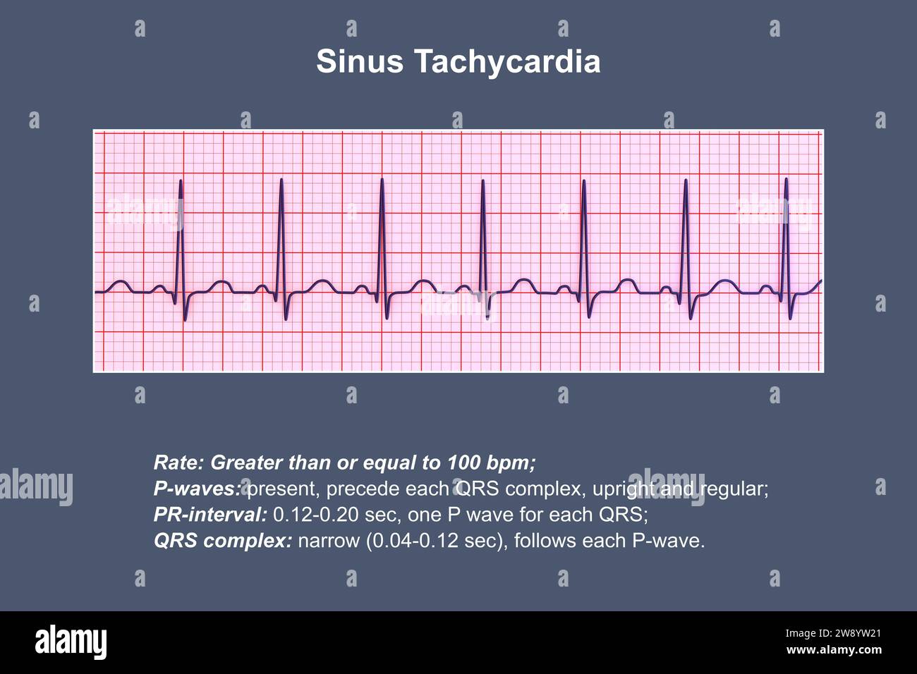 Sinus tachycardia heartbeat rhythm, illustration Stock Photo - Alamy