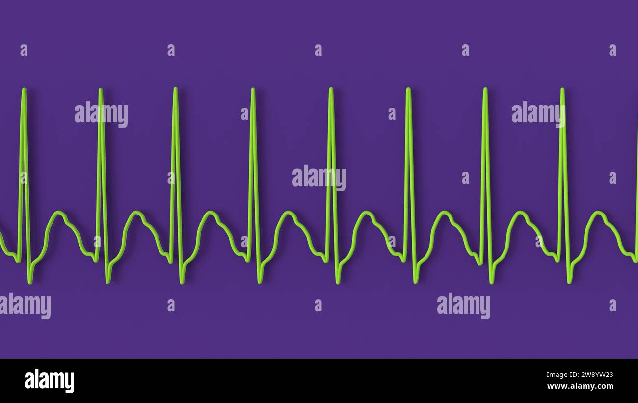 Illustration Of An Electrocardiogram Ecg Showing Supraventricular Tachycardia A Rapid Heart