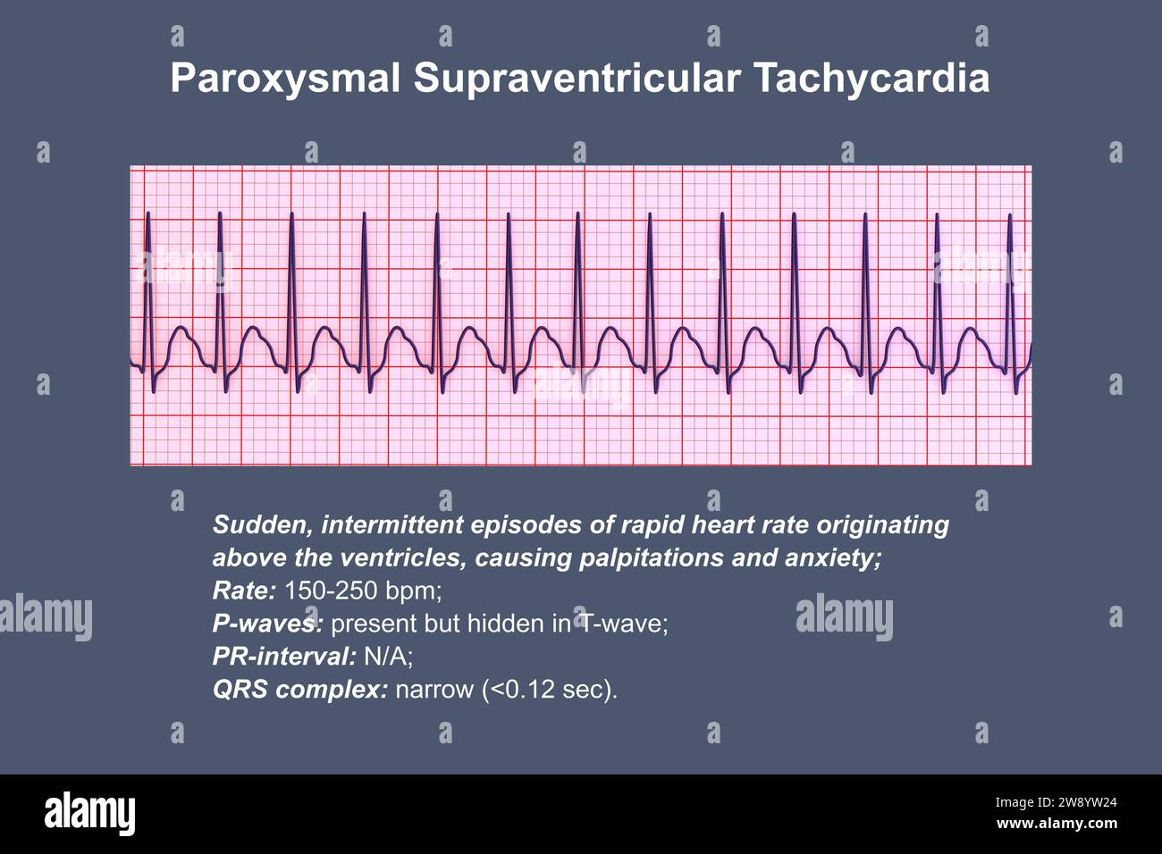 Supraventricular tachycardia heartbeat rhythm, illustration Stock Photo ...