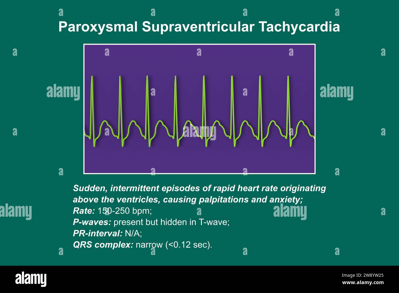 Supraventricular tachycardia heartbeat rhythm, illustration Stock Photo ...