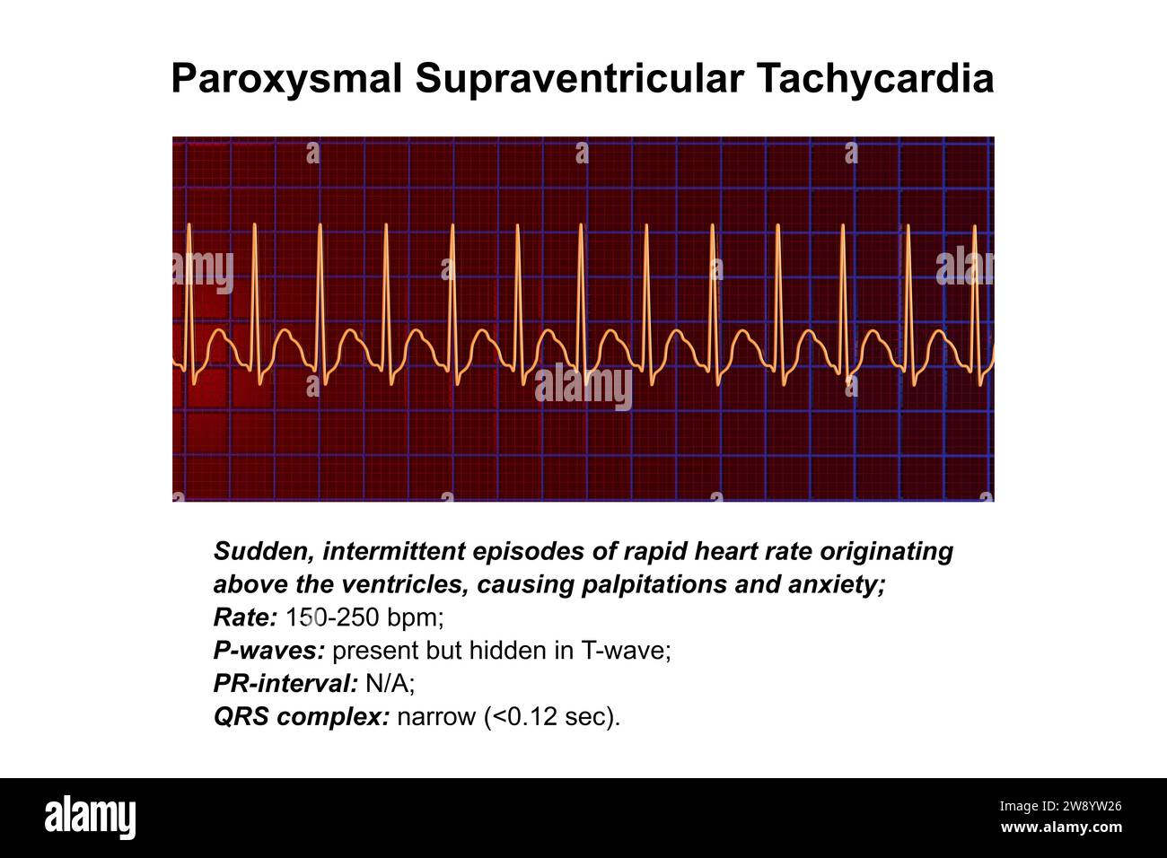 Supraventricular tachycardia heartbeat rhythm, illustration Stock Photo ...
