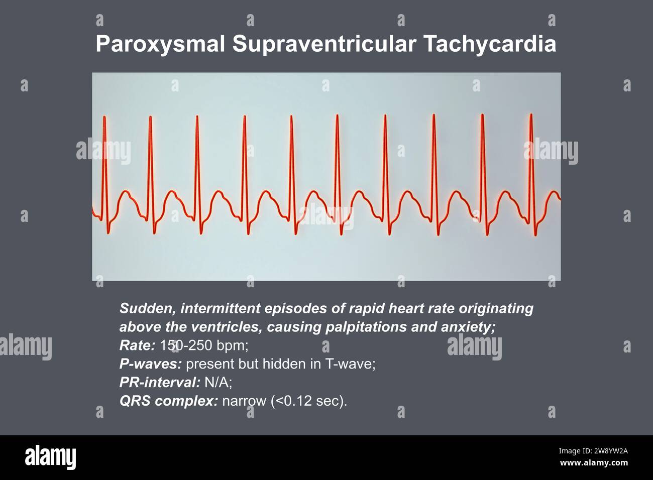 Supraventricular tachycardia heartbeat rhythm, illustration Stock Photo ...