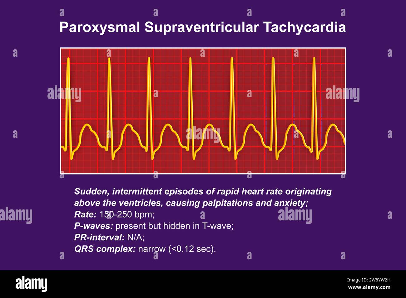 Supraventricular tachycardia heartbeat rhythm, illustration Stock Photo ...