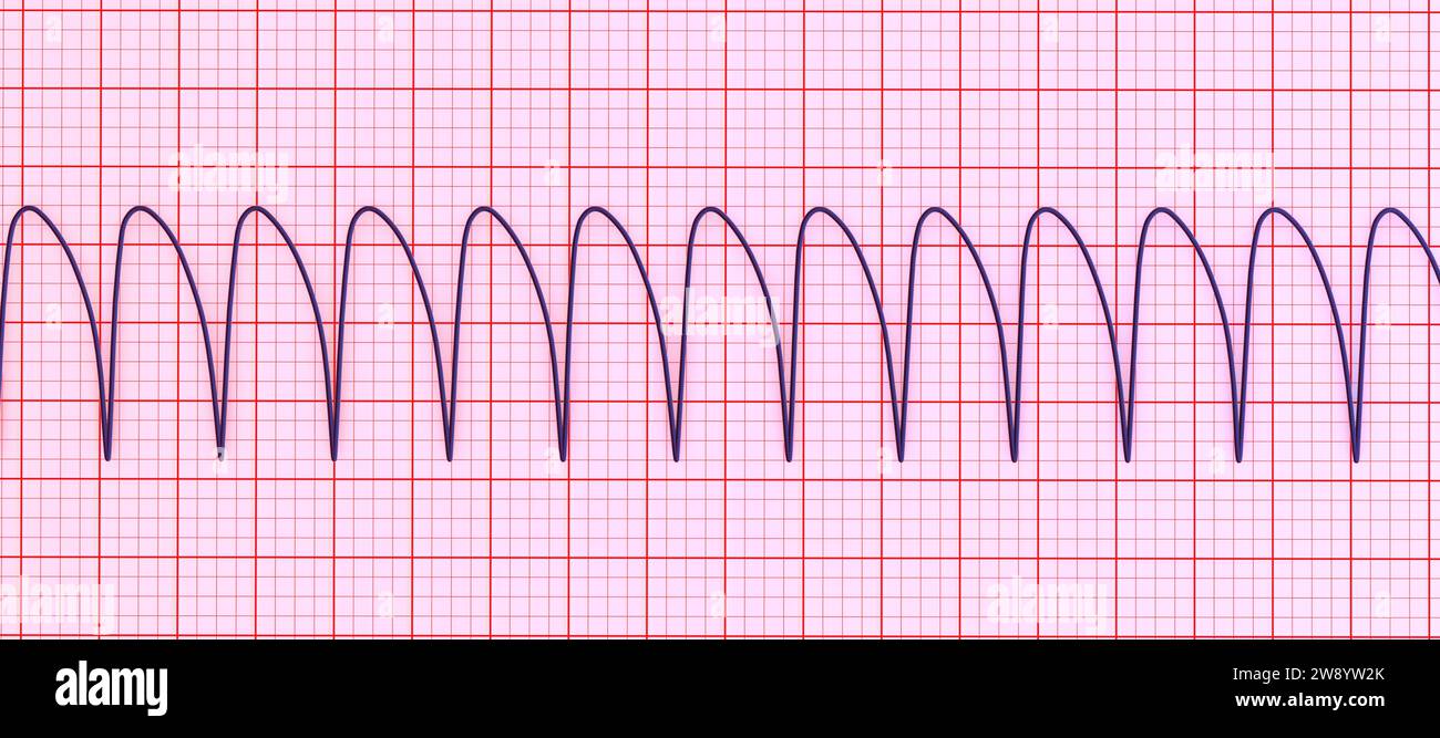 Illustration of an electrocardiogram (ECG) showing ventricular ...