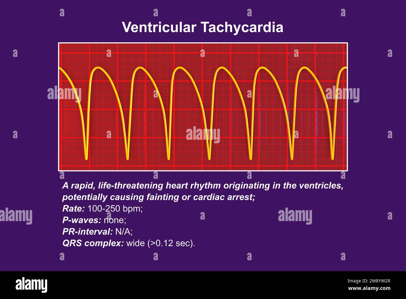 Scuba Diving With Ventricular Tachycardia at Robin Alexander blog