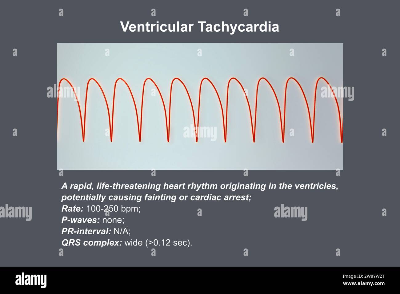 Ventricular Tachycardia Rhythm
