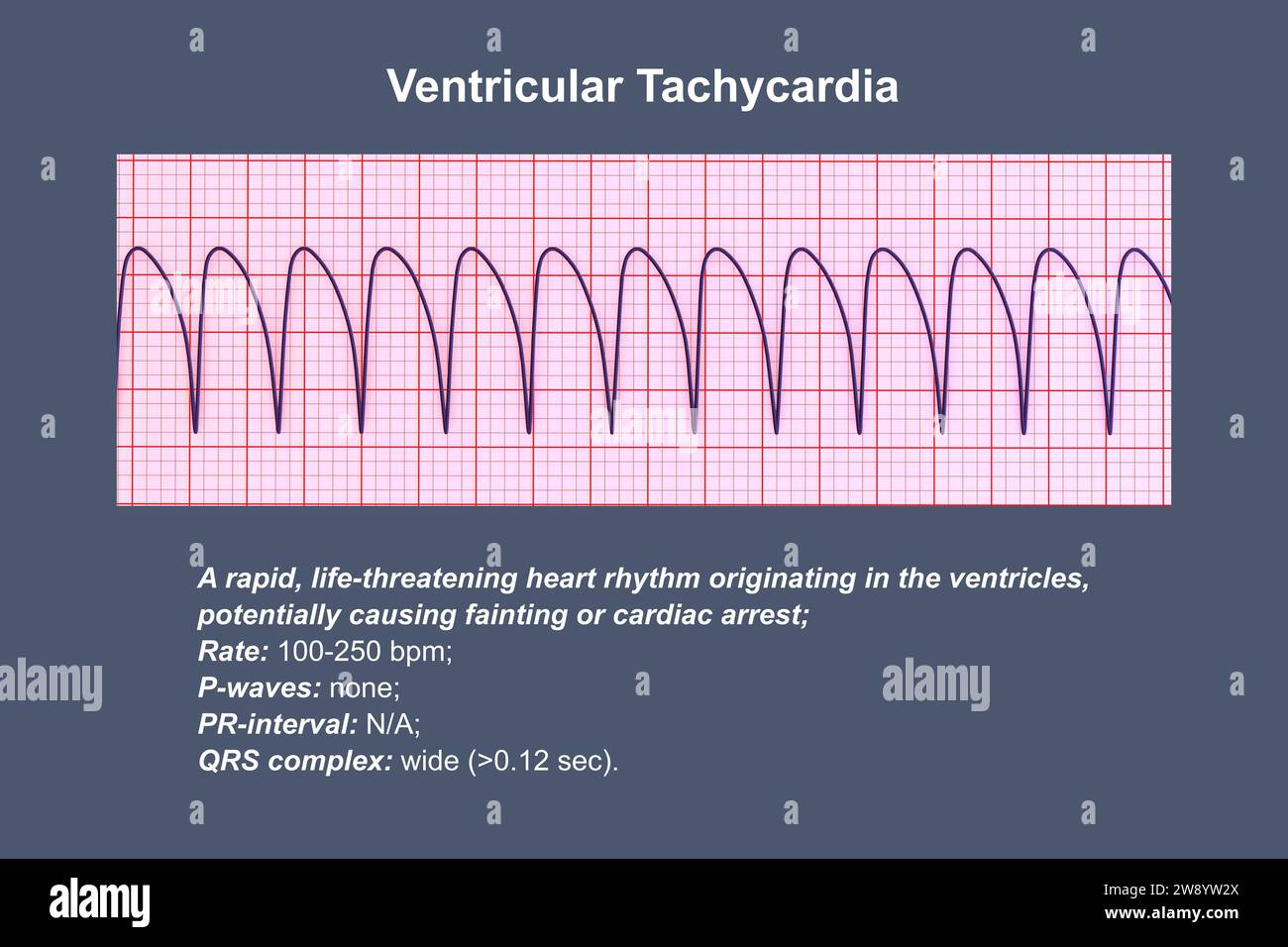 Illustration of an electrocardiogram (ECG) showing ventricular ...