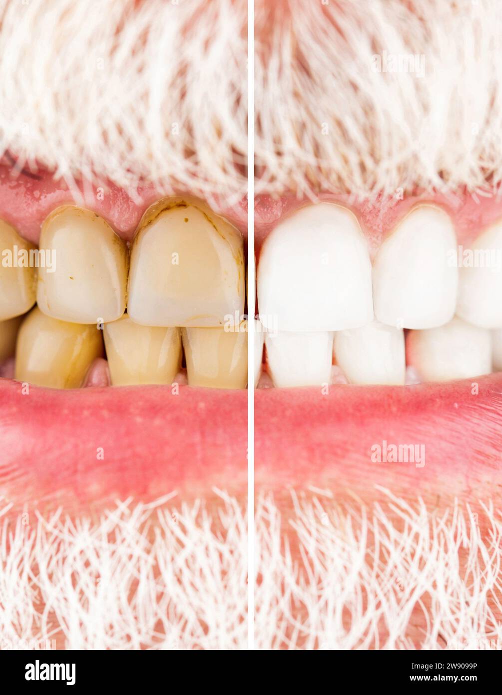 Close-up of a man teeth before and after whitening. Male teeth before ...