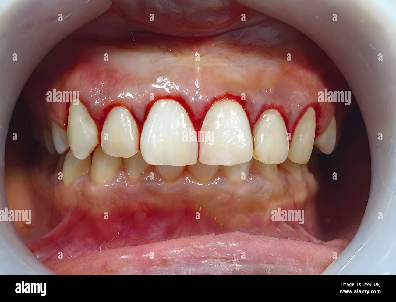 Teeth with gum bleeding hi-res stock photography and images - Alamy