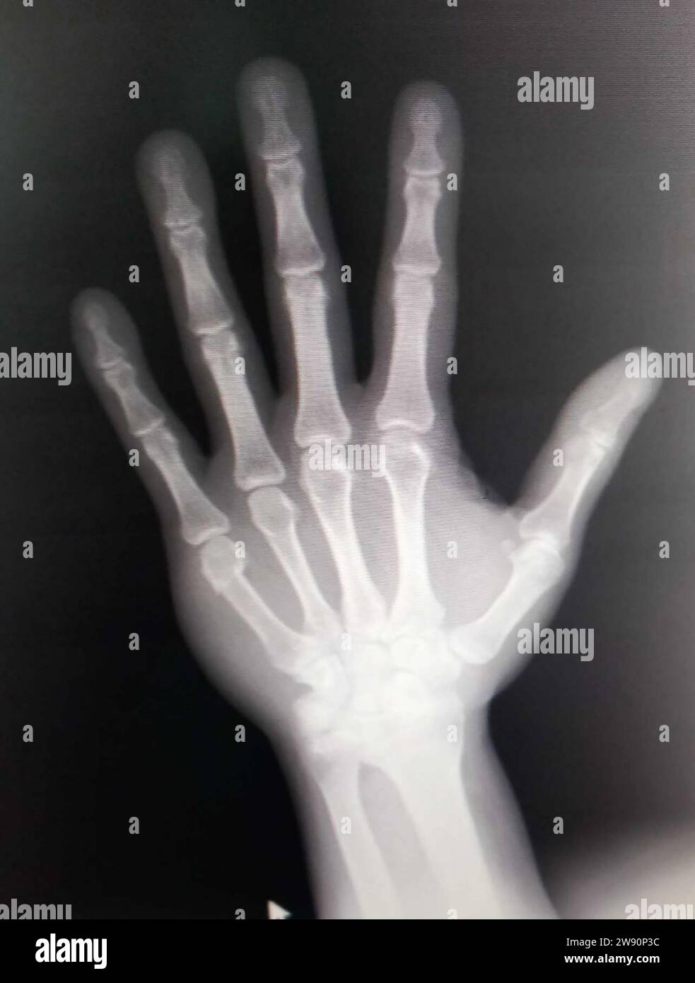 X-rayed human hand. X-ray of hand bones Stock Photo - Alamy