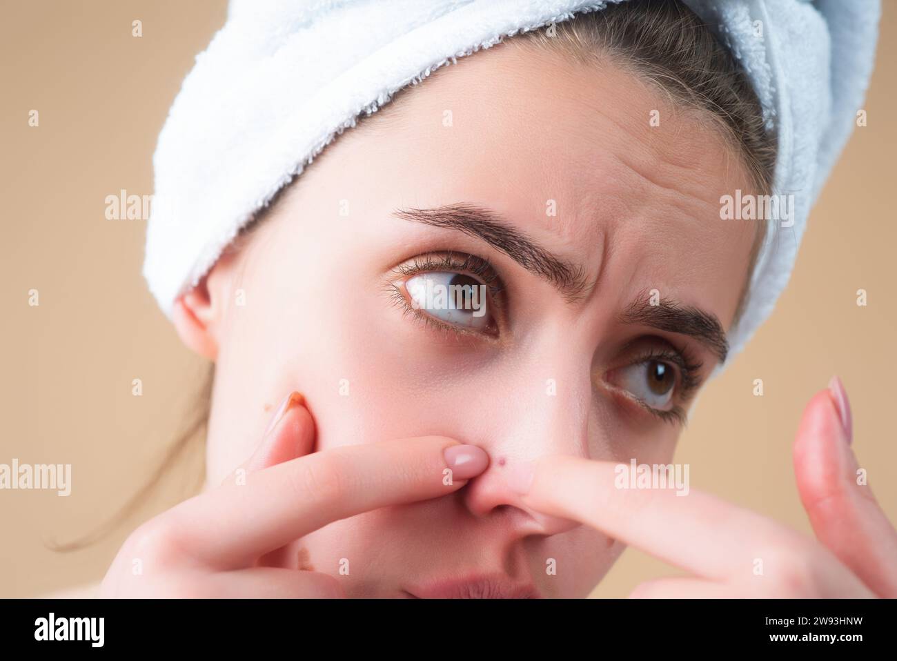 Acne. Close up acne pimple on female skin. Dermatology, puberty woman, skin reaction from ...