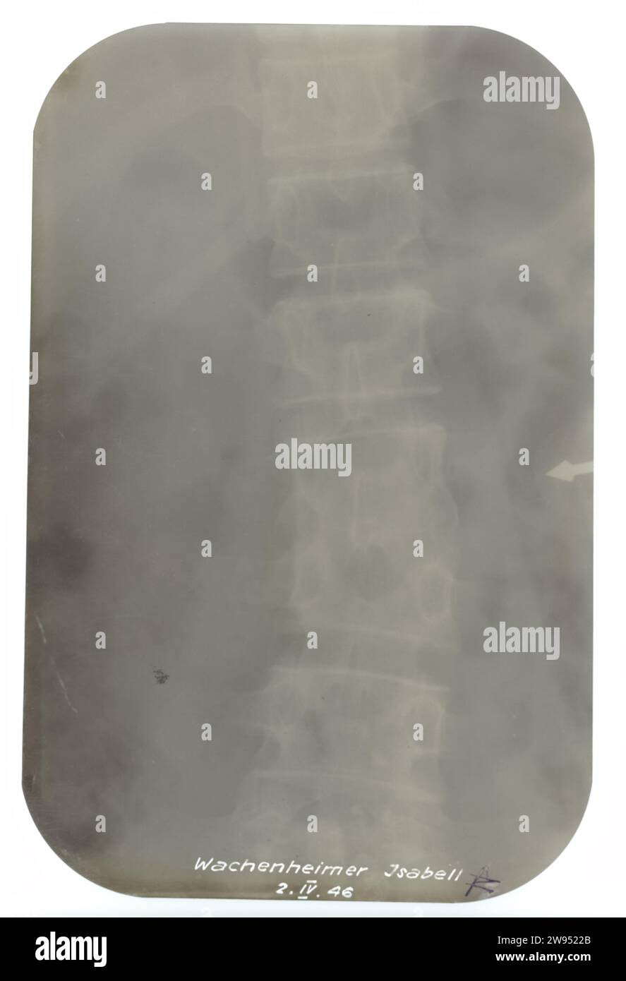 X -ray of the tbc -infected spine of Isabel Wachenheimer, dated 2 April ...