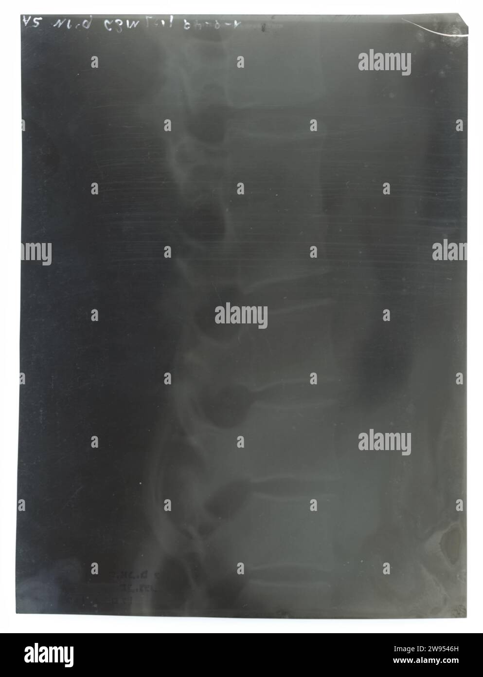 X -ray of the tbc -infected spine of Isabel Wachenheimer, dated on a ...