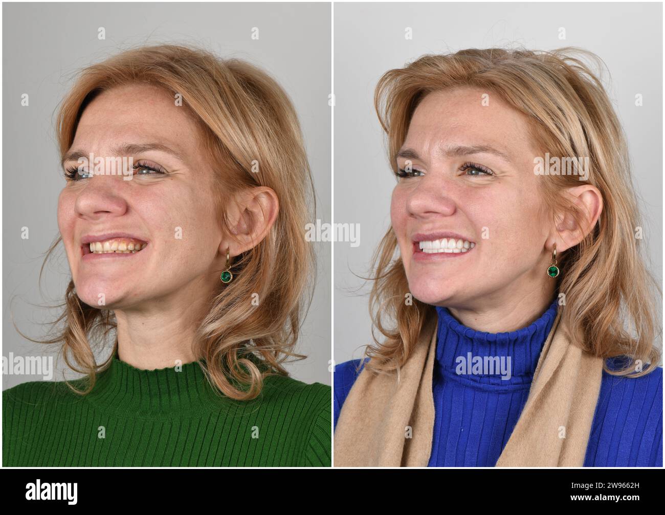 before and after picture of young lady after dental treatment Stock ...