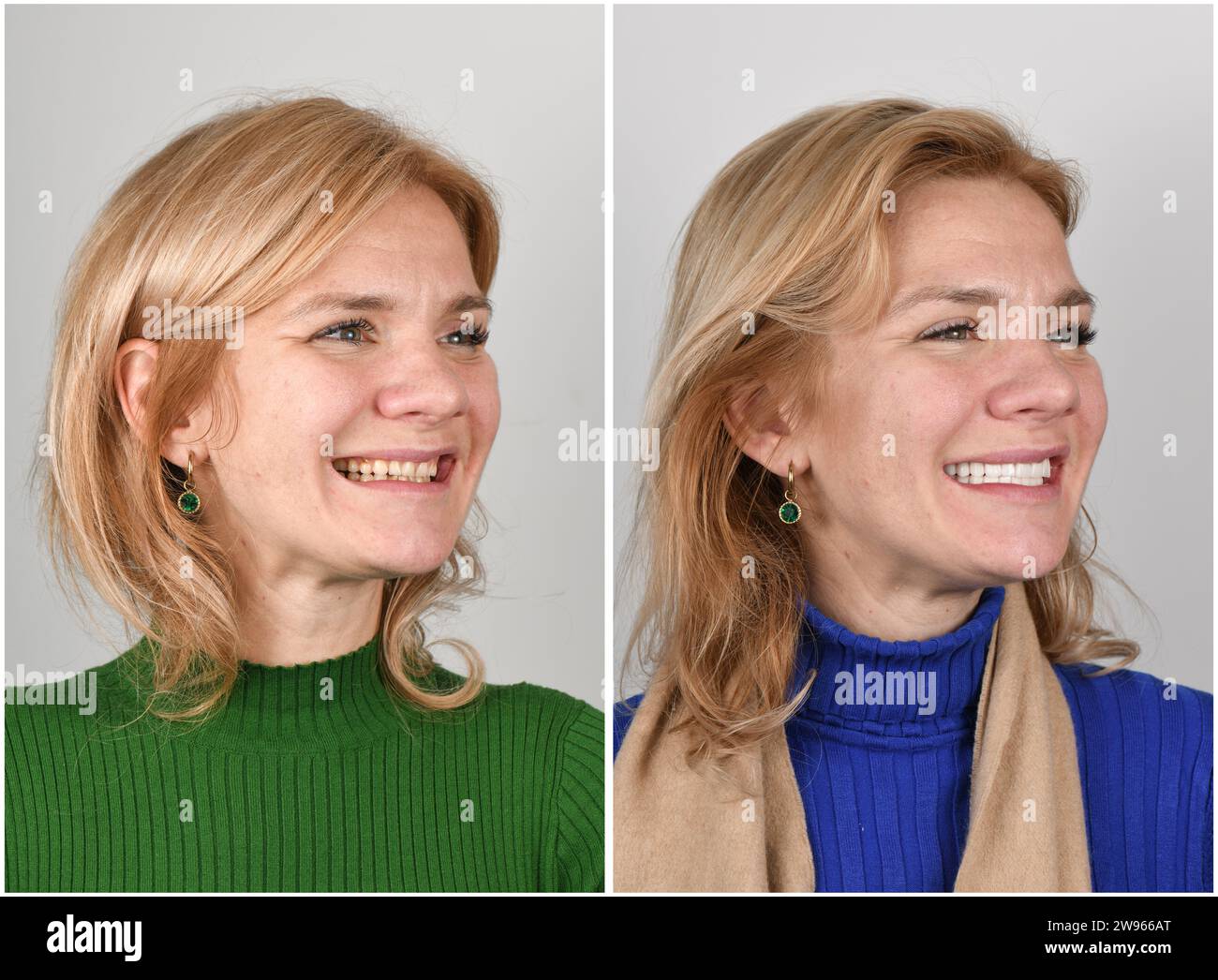 before and after picture of young lady after dental treatment Stock ...