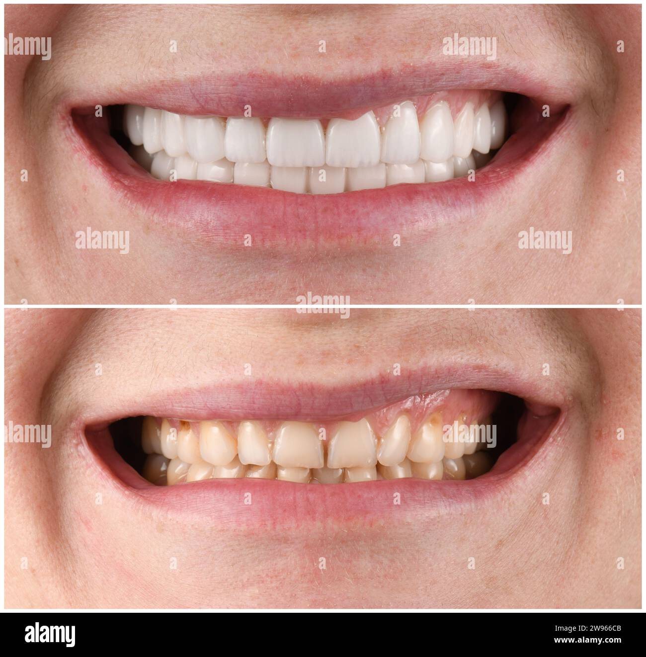 before and after picture of dental veneer and Hollywood smile Stock ...
