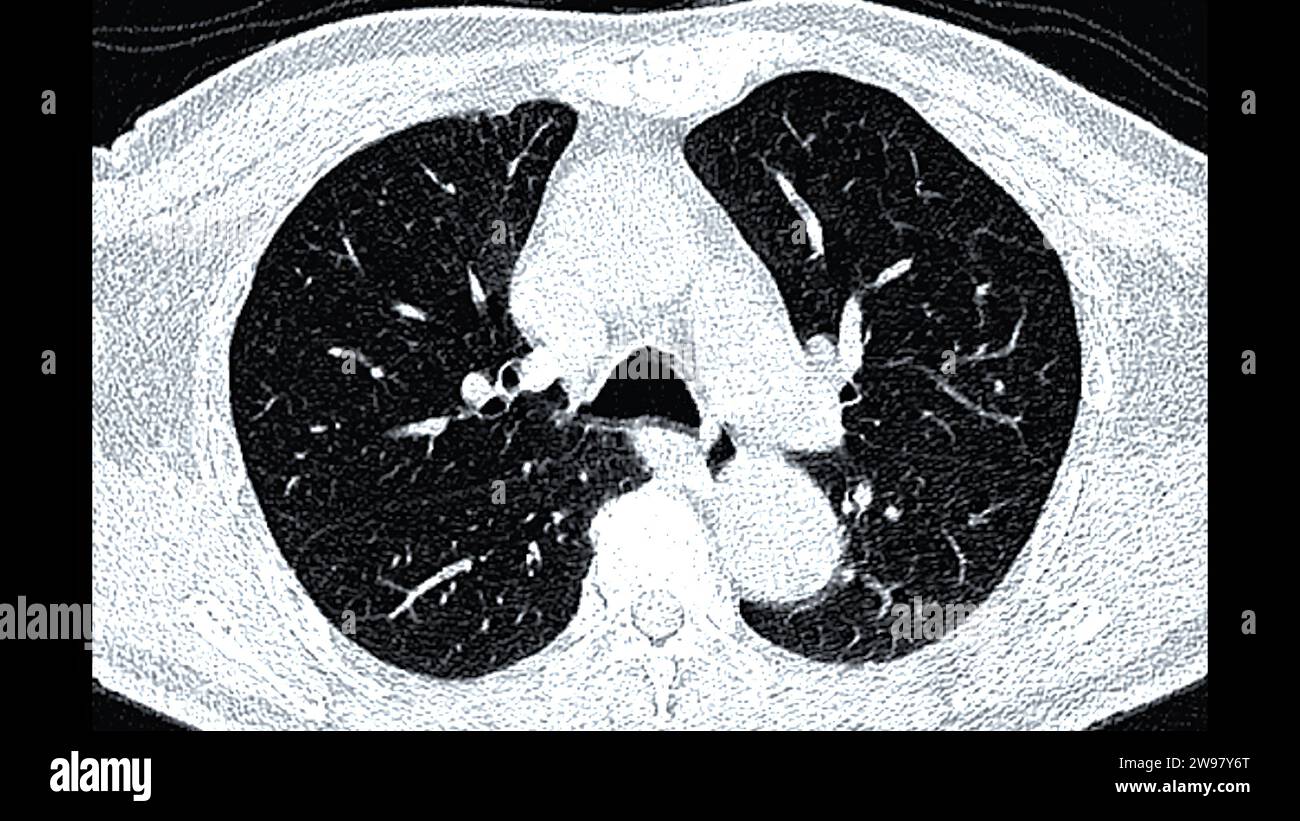 Ct Scan Of Chest Or Lung Axial View For Screening Lung Nodules And Lung