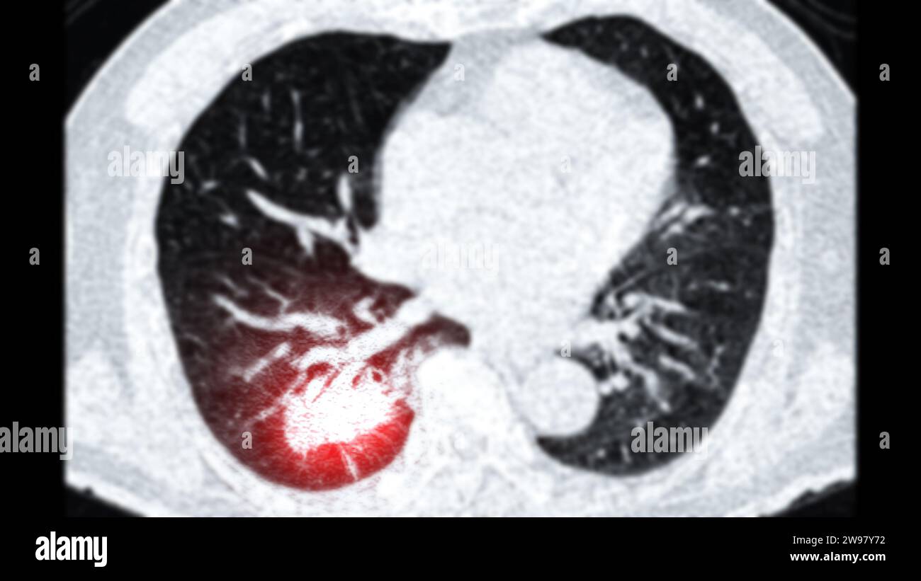 CT scan of Chest or lung axial viewshowing lung cancer lung cancer ...