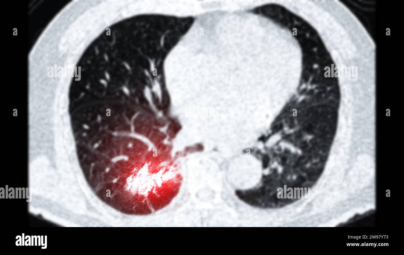CT scan of Chest or lung axial viewshowing lung cancer lung cancer ...