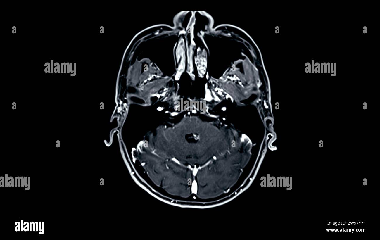 MRI brain scans axial view offer valuable insights into brain anatomy ...