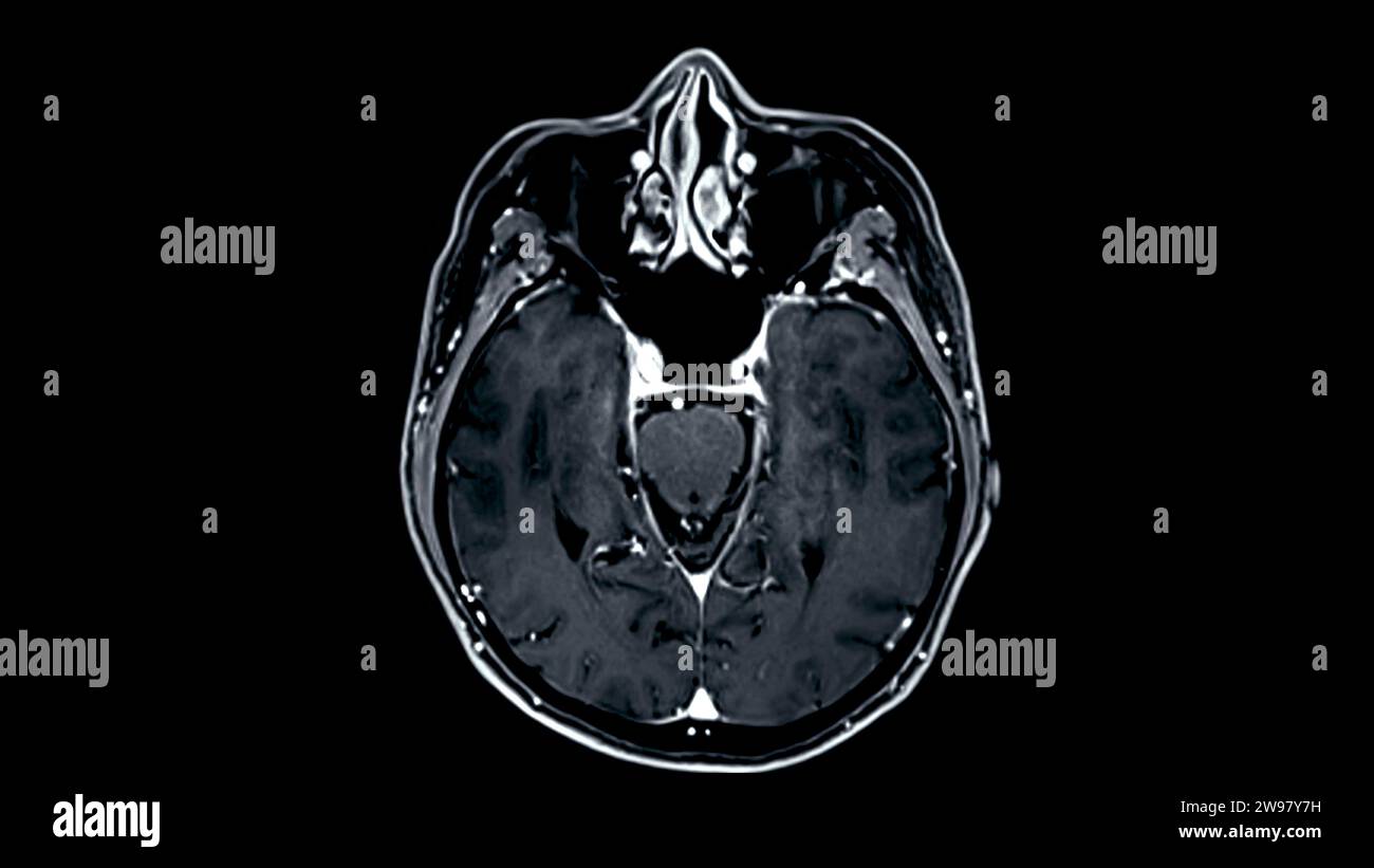 MRI brain scans axial view offer valuable insights into brain anatomy ...