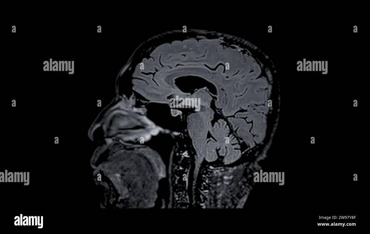 MRI brain scans sagittal view offer valuable insights into brain ...