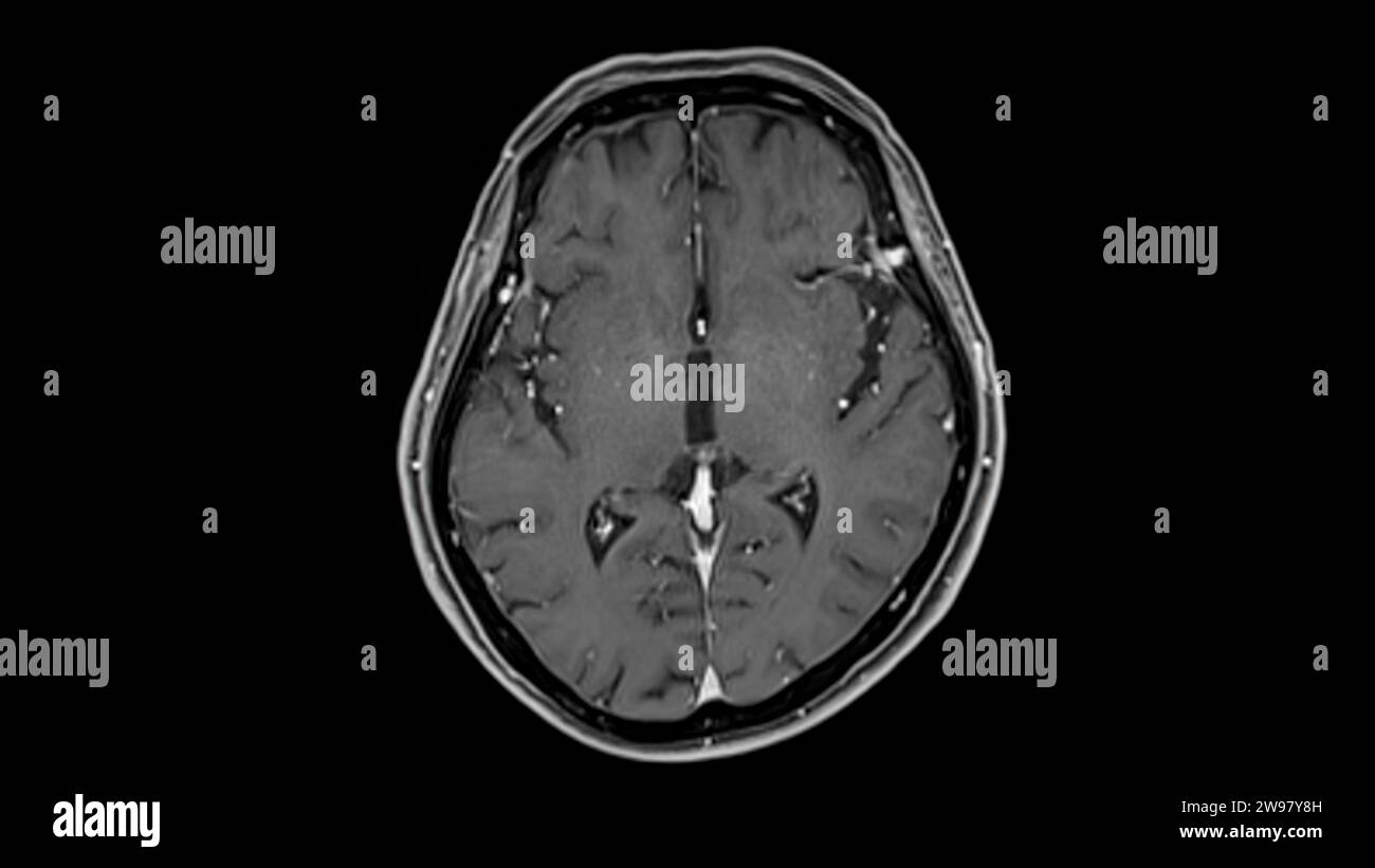 Axial Mri Brain Anatomy
