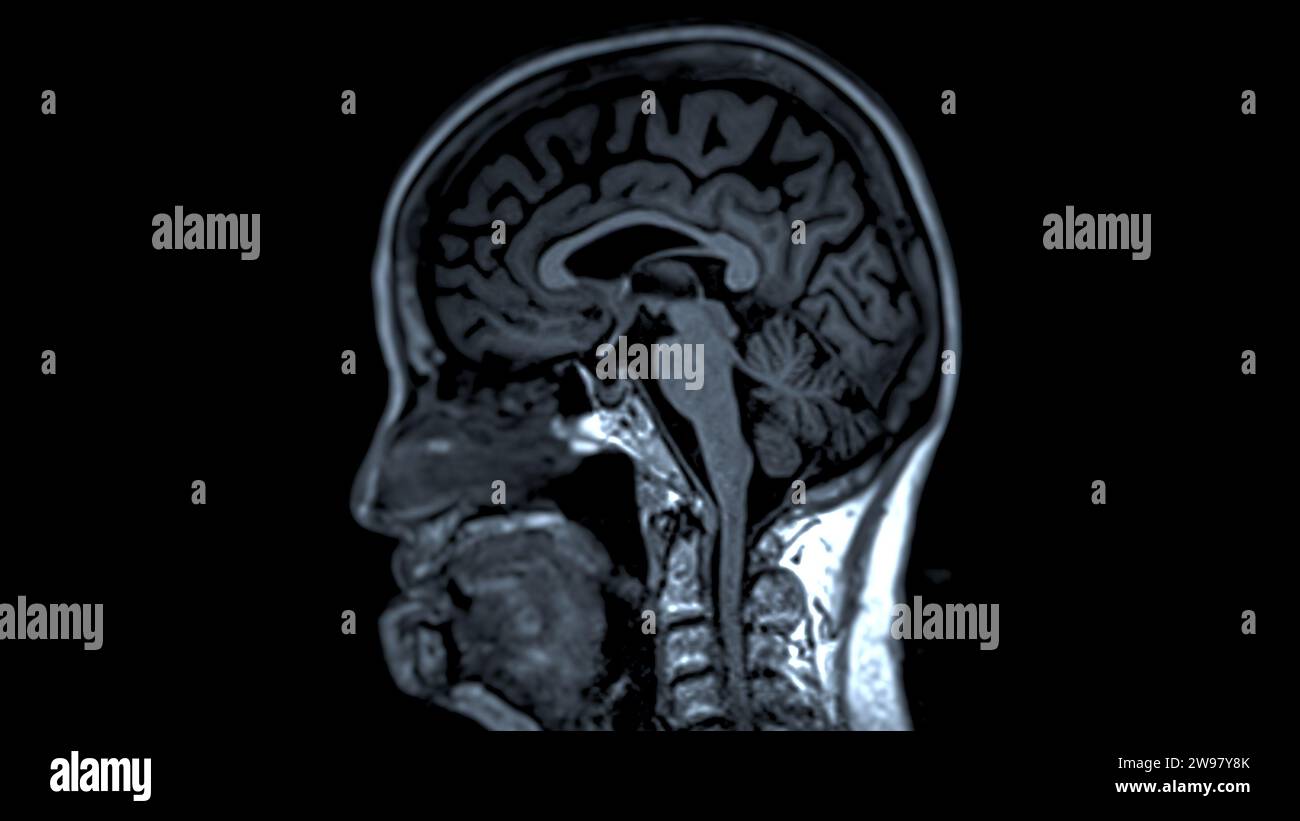 MRI brain scans sagittal view offer valuable insights into brain ...