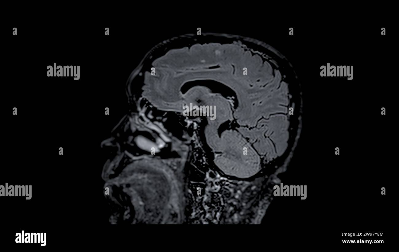 MRI brain scans sagittal view offer valuable insights into brain ...
