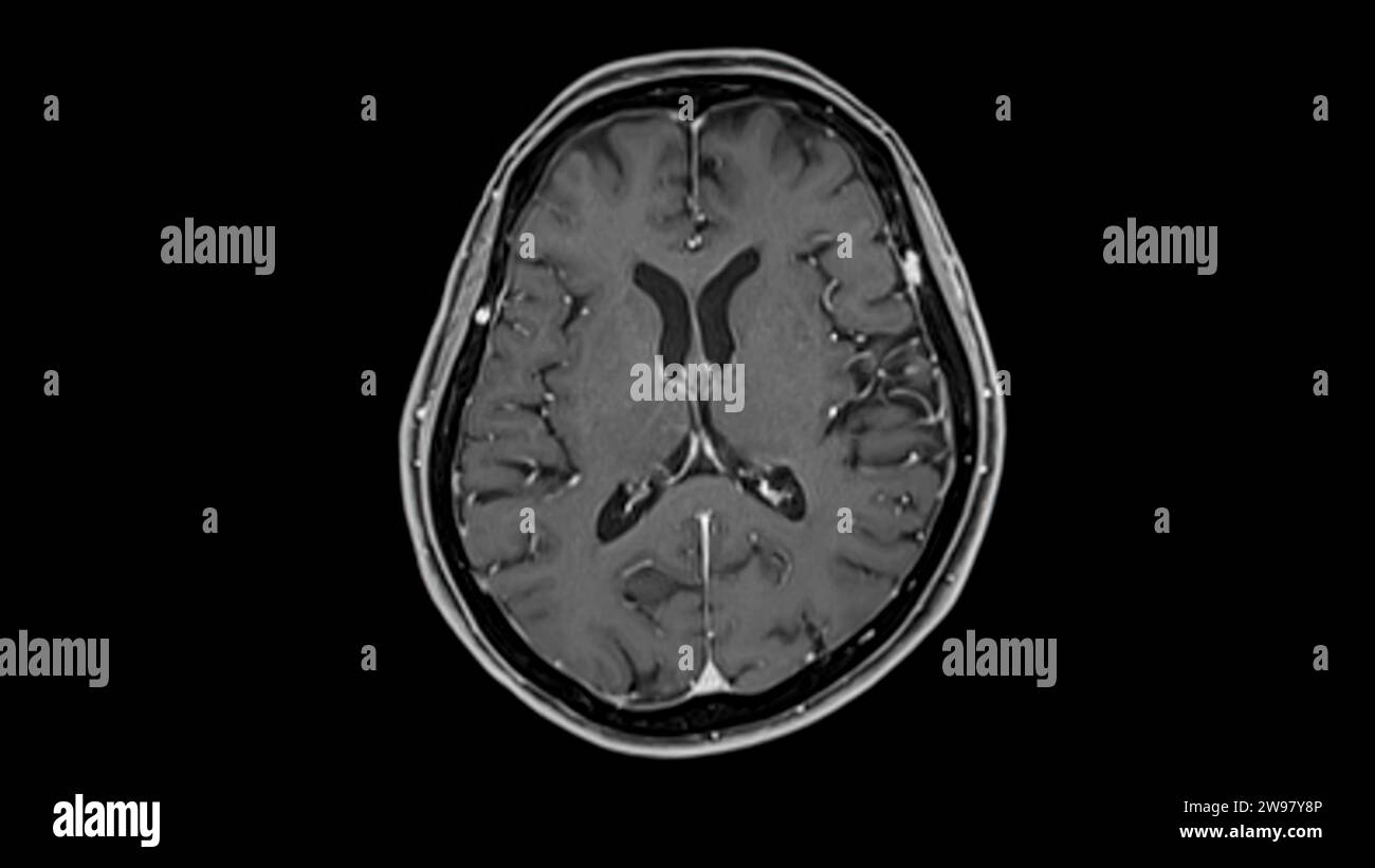 MRI brain scans axial view offer valuable insights into brain anatomy ...